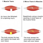 Microdiscectomy and Low Back Pain: Failed Back Surgery Syndrome
